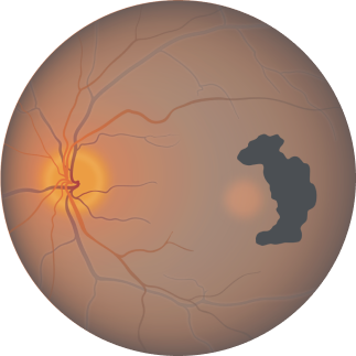 Geographic Atrophy UK | GA Disease Progression | Apellis