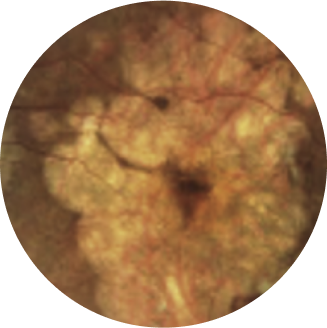 Geographic Atrophy UK | What is GA | Apellis