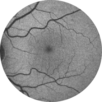 Geographic Atrophy UK | What is GA | Apellis
